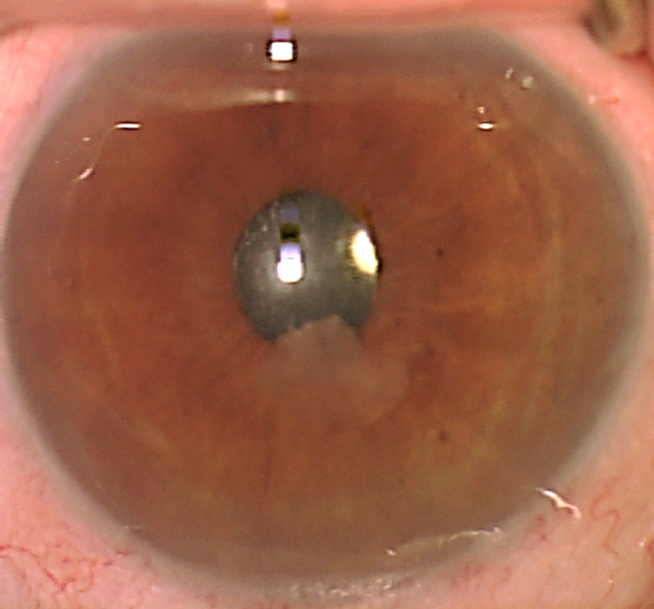 Case Report: Searching for the Cause of a Red, Painful Eye ...