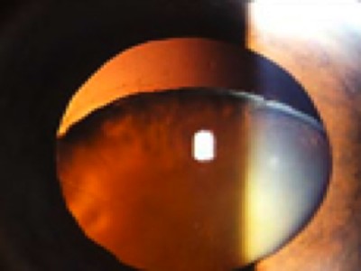 A patient with phacodonesis and cataract as shown in the photo desires ...