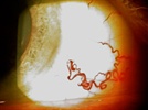 The Unusual Cataract: A Case Report | ophthalmologyweb.com
