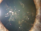 Case Report: Unusual Cataract | ophthalmologyweb.com