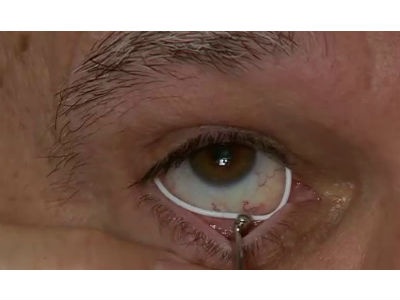 Drug-Dispensing Ring Shows Promise as Option for Glaucoma Treatment ...
