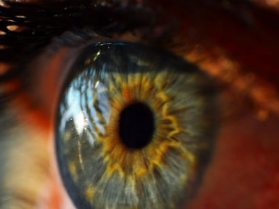 Technology Update: Corneal Inlays | ophthalmologyweb.com