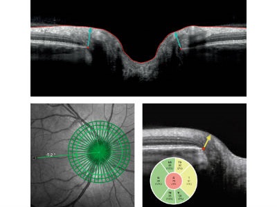 Heidelberg Receives FDA Clearance for SPECTRALIS OCT Glaucoma Module ...