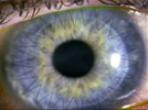 Refractive Surgery and H1N1 | ophthalmologyweb.com