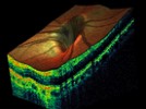 Optic Nerve and RNFL: I Want My Imaging | ophthalmologyweb.com