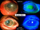Amniotic Membrane in Ophthalmology | ophthalmologyweb.com