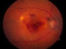VEGF Trap for AMD: Phase 3 Clinical Trial | ophthalmologyweb.com