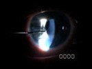 Micro Striae: A LASIK Complication with a Simple Solution ...