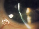 The following is a slit lamp photograph of a 60 year old woman with ...