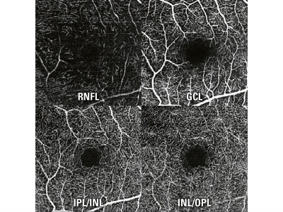 Heidelberg Introduces OCT Angiography Module for Spectralis ...