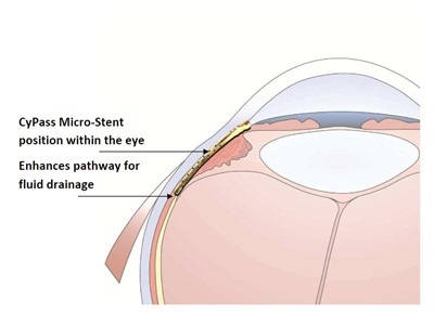 Favorable Trial Results for CyPass® Micro-Stent for Glaucoma Patients ...