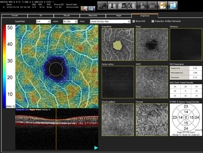 Upgraded Angiography Software Enables Visualization of Eye ...
