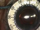 Toric Intraocular Lens Alignment | ophthalmologyweb.com