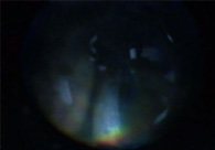 Choroidal Drainage Using 25 Gauge Instrumentation | ophthalmologyweb.com
