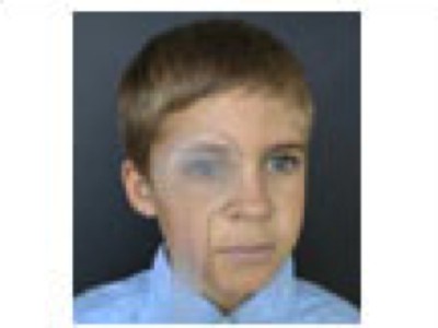 Occluders | OphthalmologyWeb: The Ultimate Online Resource for ...