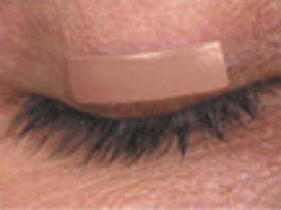 External Eyelid Weights | OphthalmologyWeb: The Ultimate Online ...