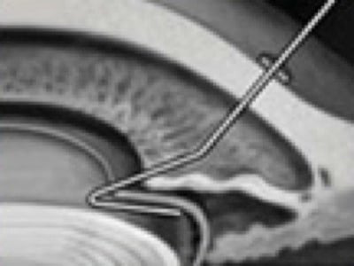 Iris Hooks | OphthalmologyWeb: The Ultimate Online Resource for ...